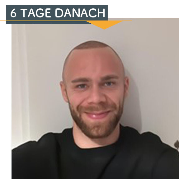 Haartransplantation von Alexander Schlager | Moser Medical